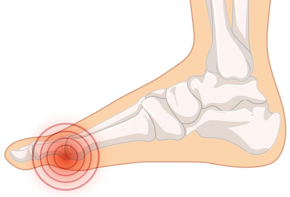 Gout - Homeopathy Hospitals Gout - Homeopathy Hospitals